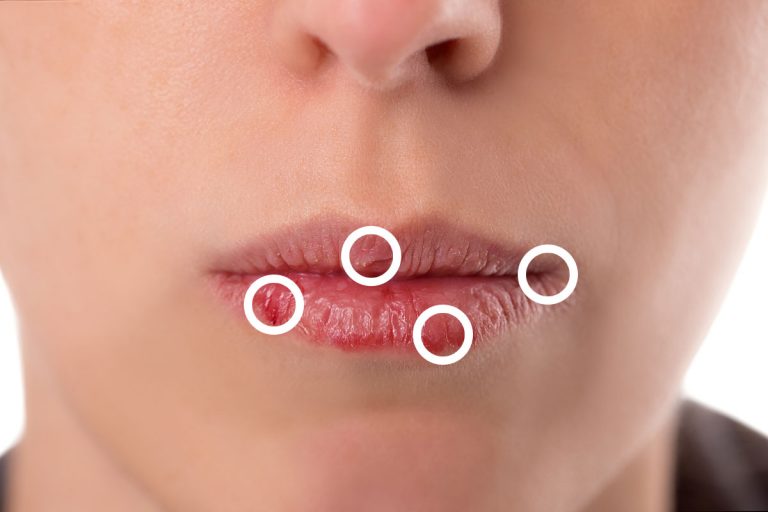Zelo suhe in razpokane ustnice: od vzrokov do rešitve | Bodi eko