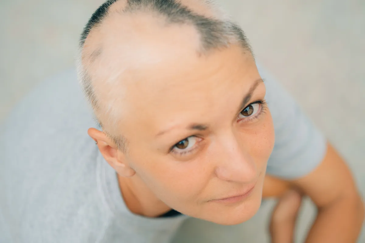Alopecija areata – naravna pomoč | Bodi eko